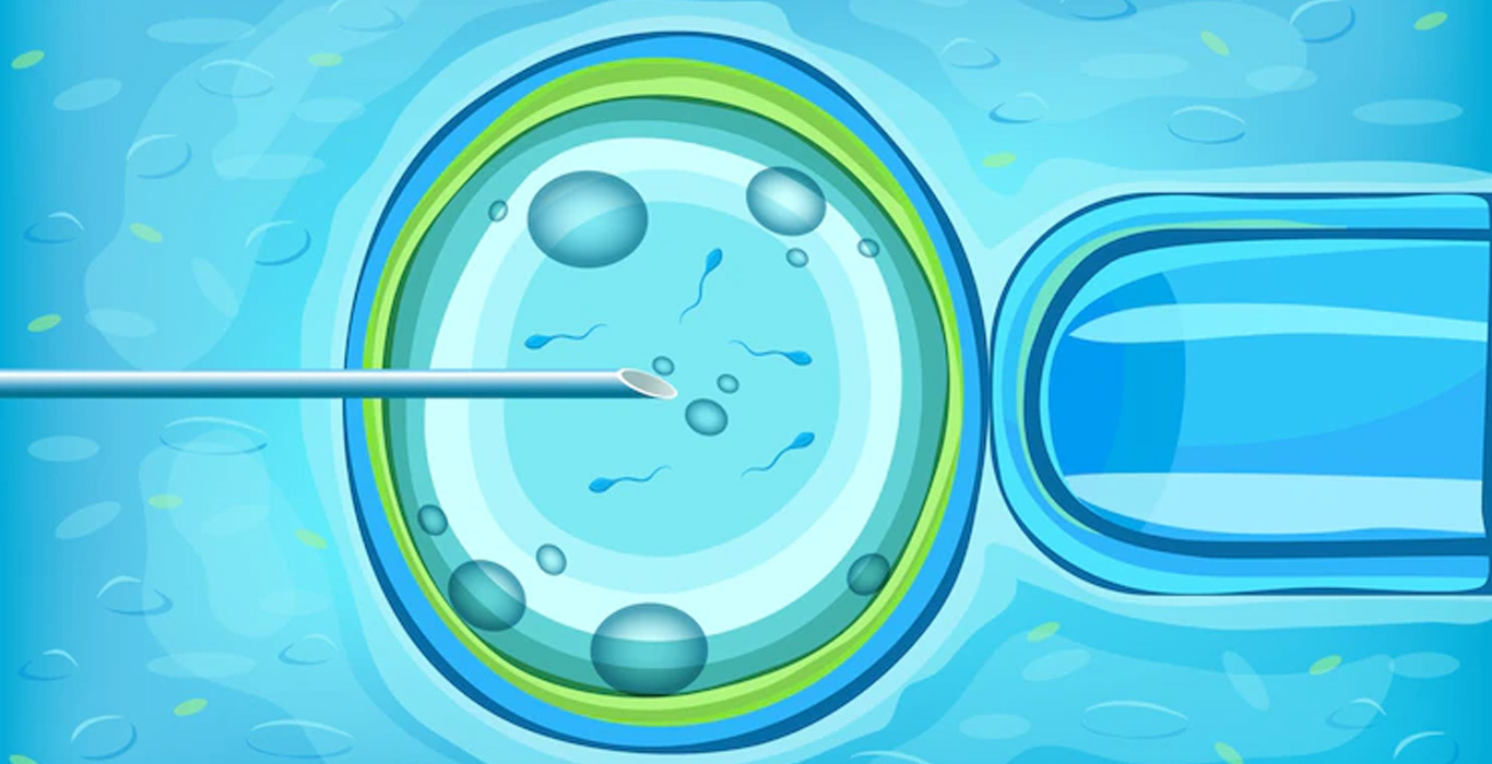 What is IVF? A Complete Guide to Fertility Treatment