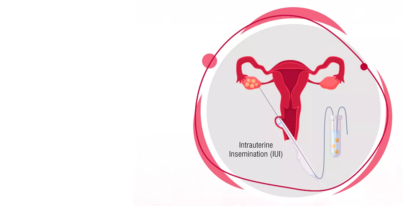 IUI Process: Understanding IUI Procedure Step by Step | Indira IVF